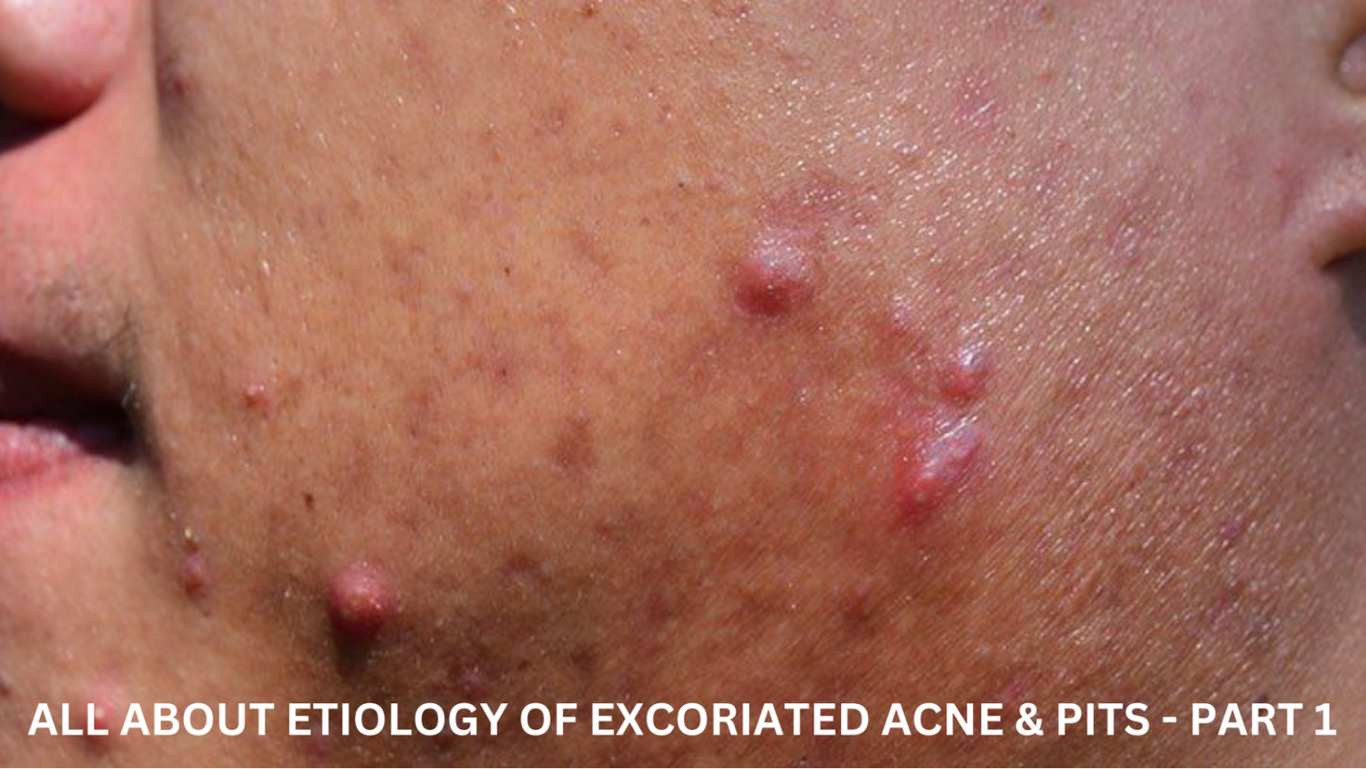 ALL ABOUT ETIOLOGY OF EXCORIATED ACNE & PITS – PART 1 – Juvenas.com