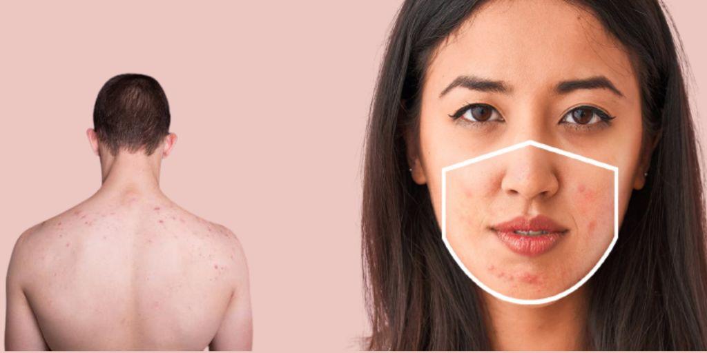 What Are Backne And Maskne? – Juvenas.com